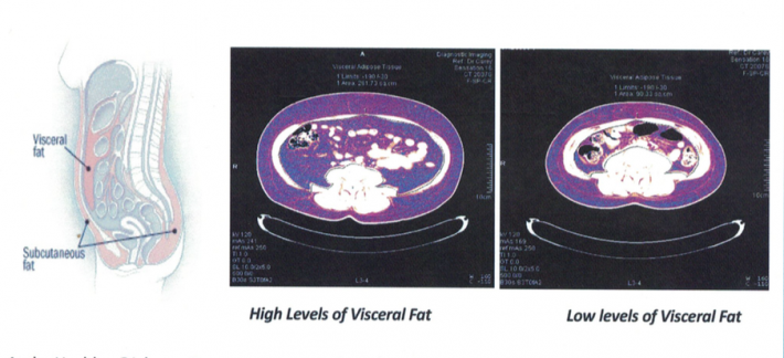 Body Fat Distribution | Health+ Diabetes – Endocrinologist Dr David Carey